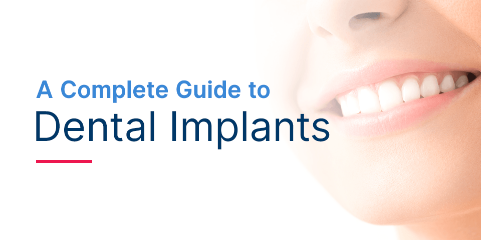 Dental Implant Guide: What You Need To Know | Hiossen® Implant