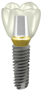 ETII Implant System | Hiossen® Implant